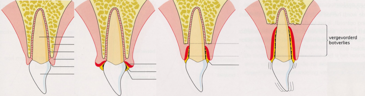 Parodontologie - Staas en Bergmans - Tandartsenpraktijk 's Hertogenbosch